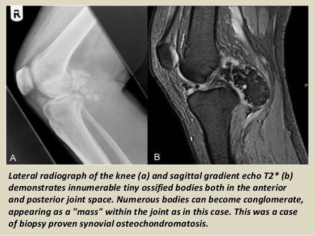 Presentation1, radiological imaging of popliteal fossa masses.