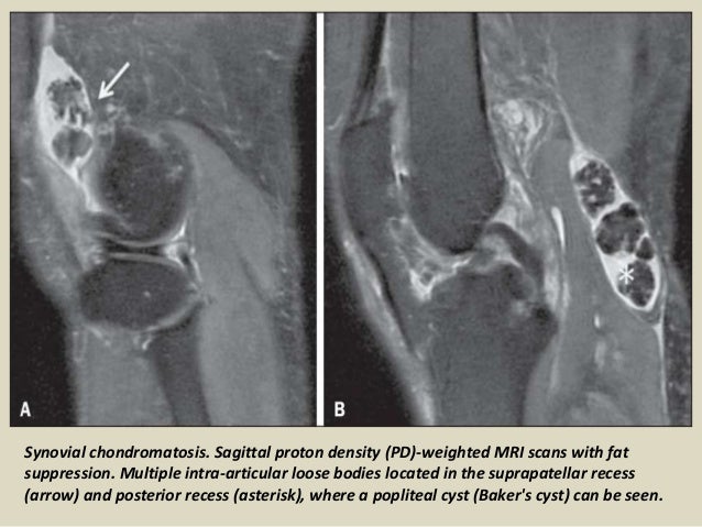 Presentation1, radiological imaging of popliteal fossa masses.