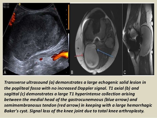Presentation1, radiological imaging of popliteal fossa masses.