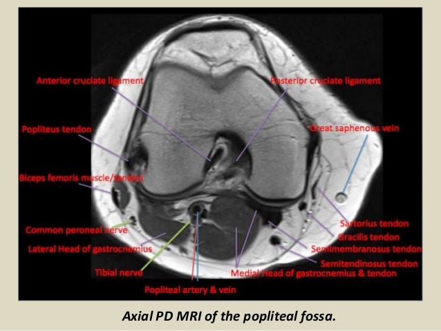 Presentation1, radiological imaging of popliteal fossa masses.