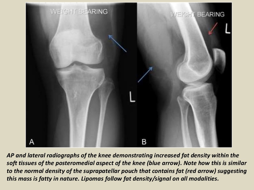 Presentation1, radiological imaging of popliteal fossa masses.