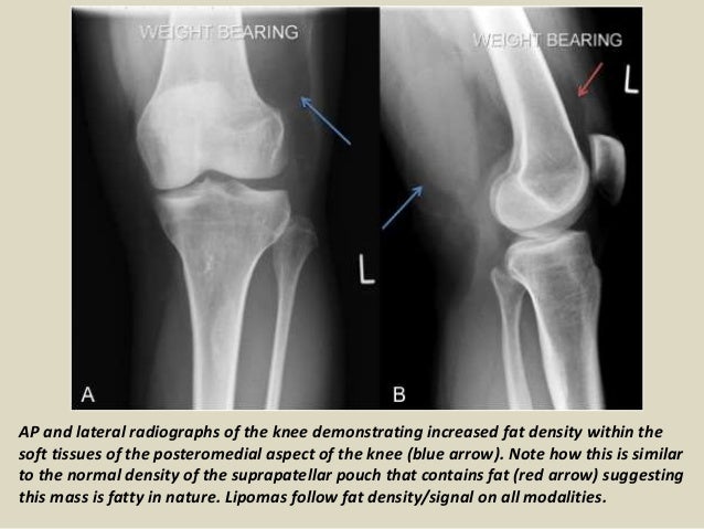 Presentation1, radiological imaging of popliteal fossa masses.