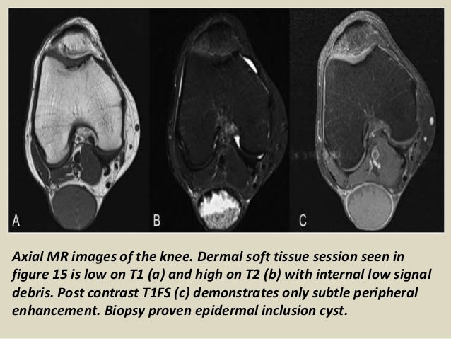 Presentation1, radiological imaging of popliteal fossa masses.