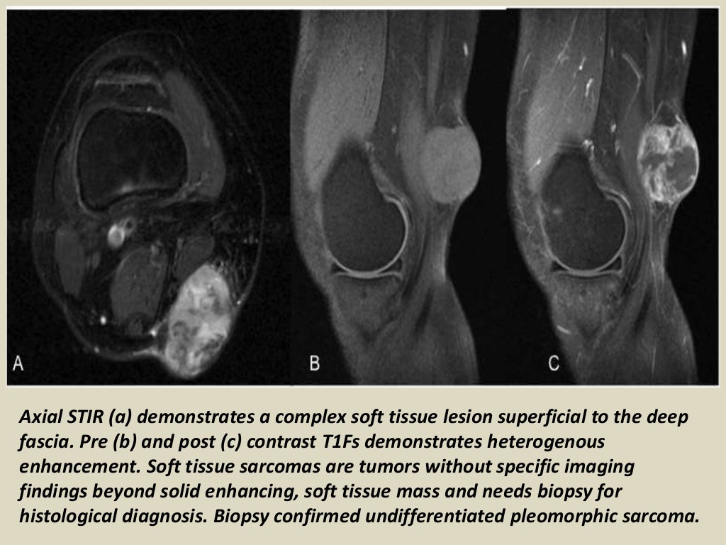 Presentation1, radiological imaging of popliteal fossa masses.
