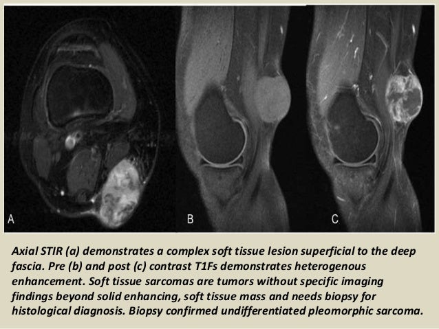 Presentation1, radiological imaging of popliteal fossa masses.