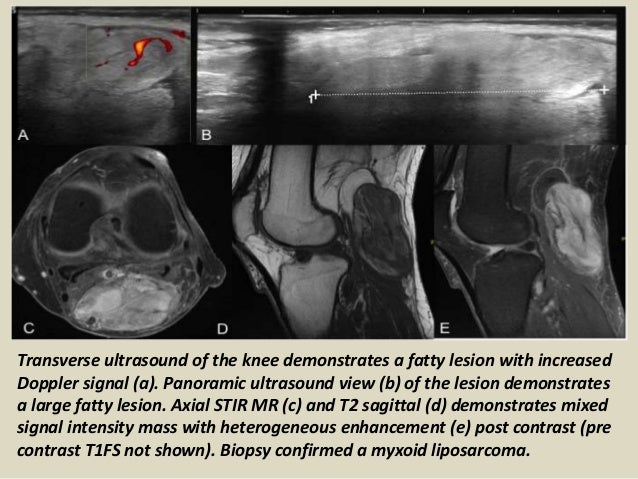 Presentation1, radiological imaging of popliteal fossa masses.