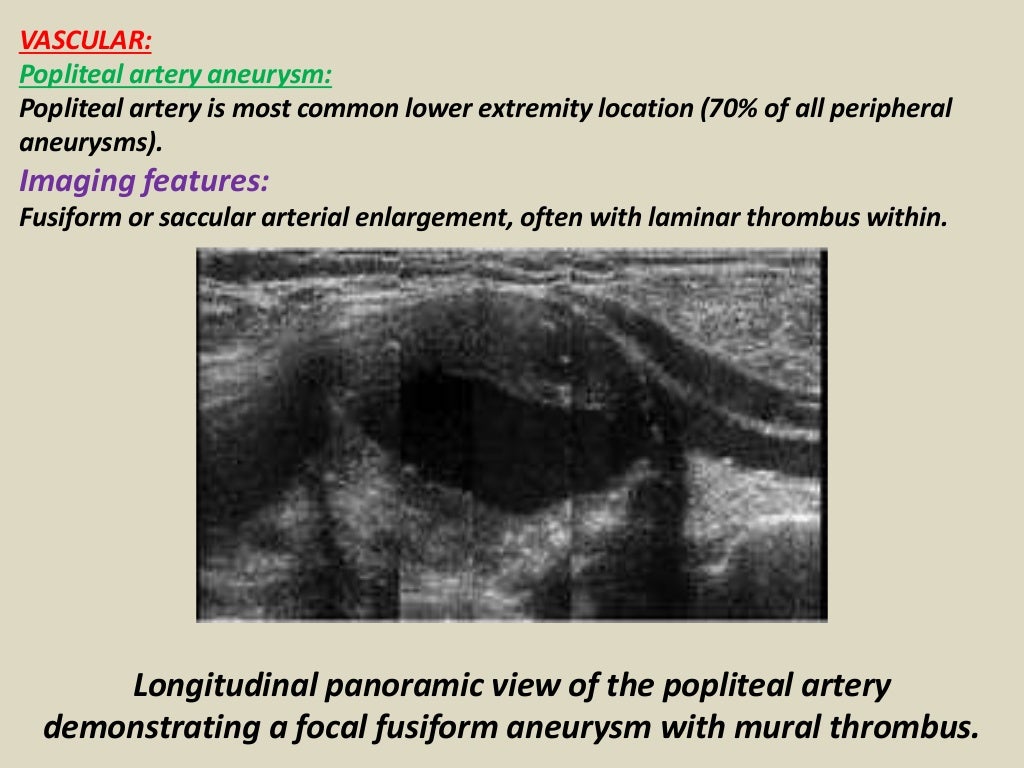 Presentation1, radiological imaging of popliteal fossa masses.