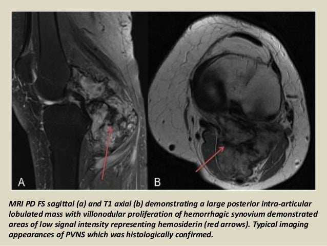 Popliteal Fossa Ultrasound Calcified Mass Imaging Of The Knee