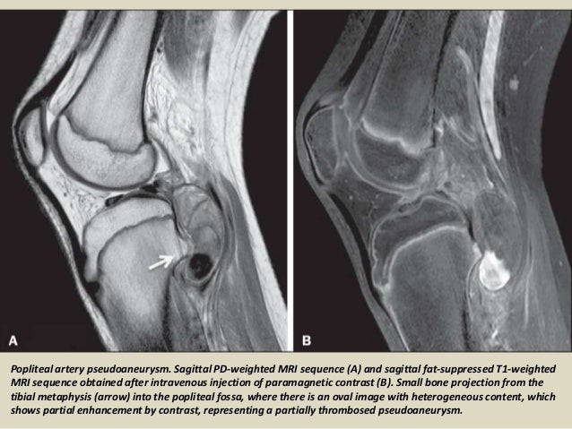 Presentation1, radiological imaging of popliteal fossa masses.
