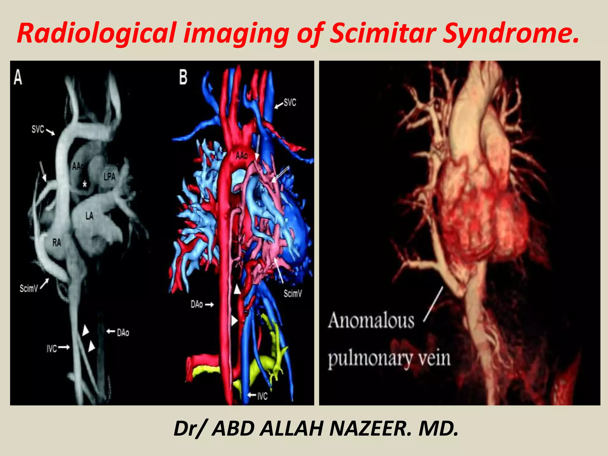Presentation1, radiological imaging of scimitar syndrome | PPTX