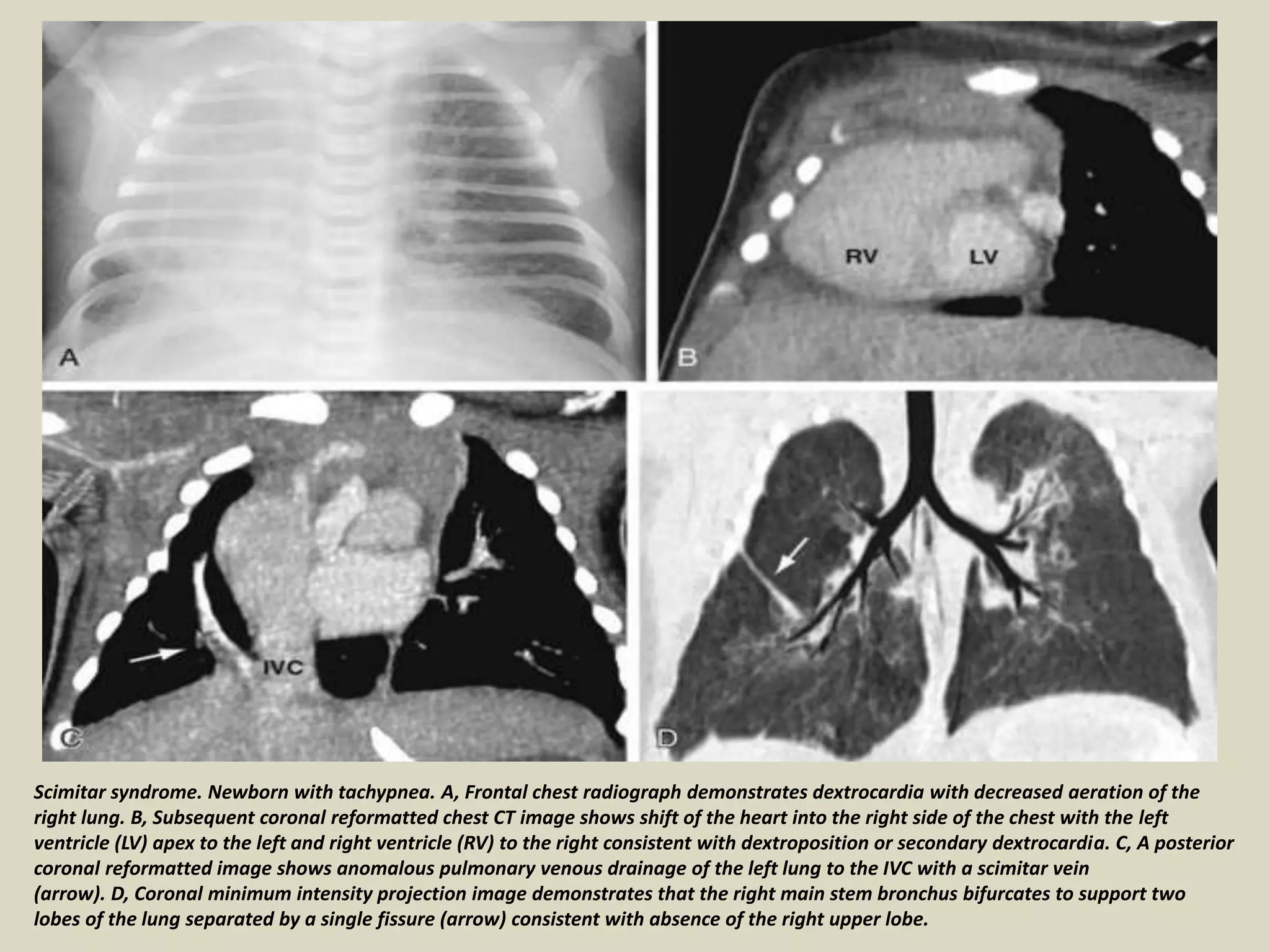 Presentation1, radiological imaging of scimitar syndrome | PPTX