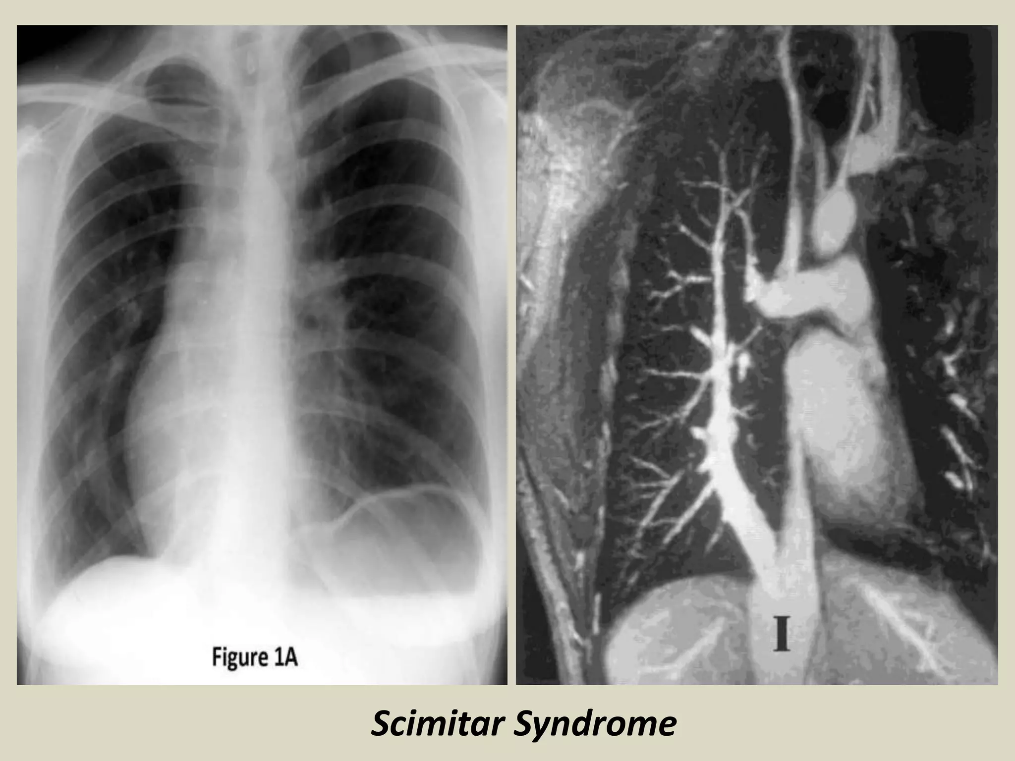 Presentation1, radiological imaging of scimitar syndrome | PPTX