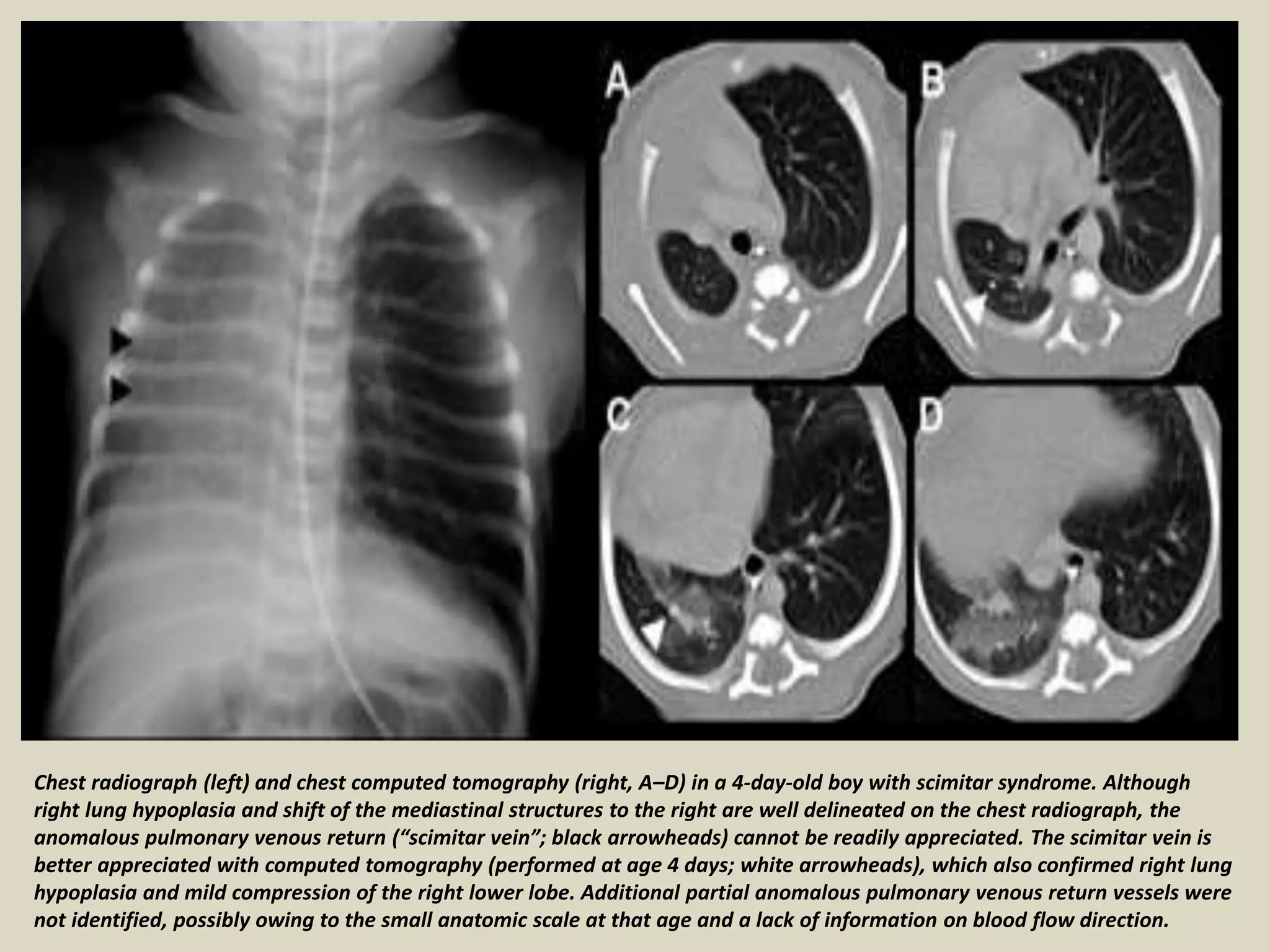 Presentation1, radiological imaging of scimitar syndrome | PPTX