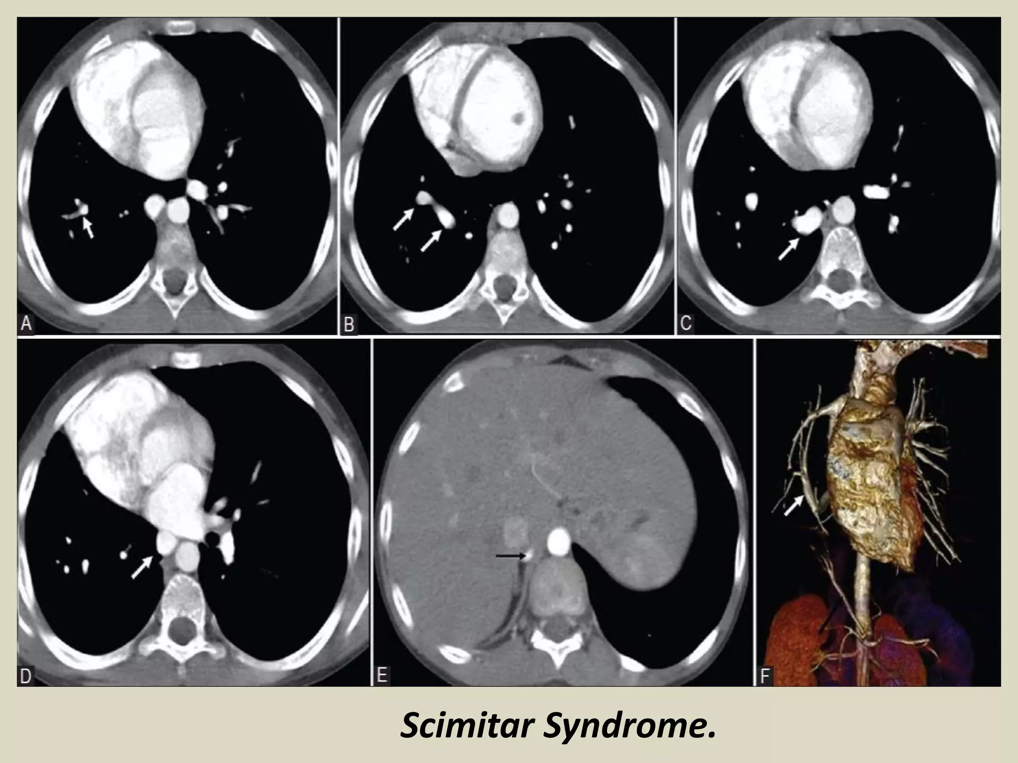 Presentation1, radiological imaging of scimitar syndrome | PPTX