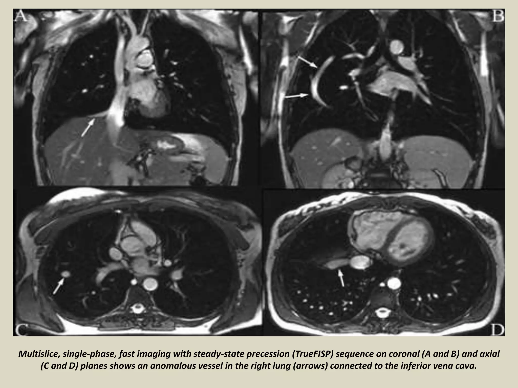 Presentation1, radiological imaging of scimitar syndrome | PPTX