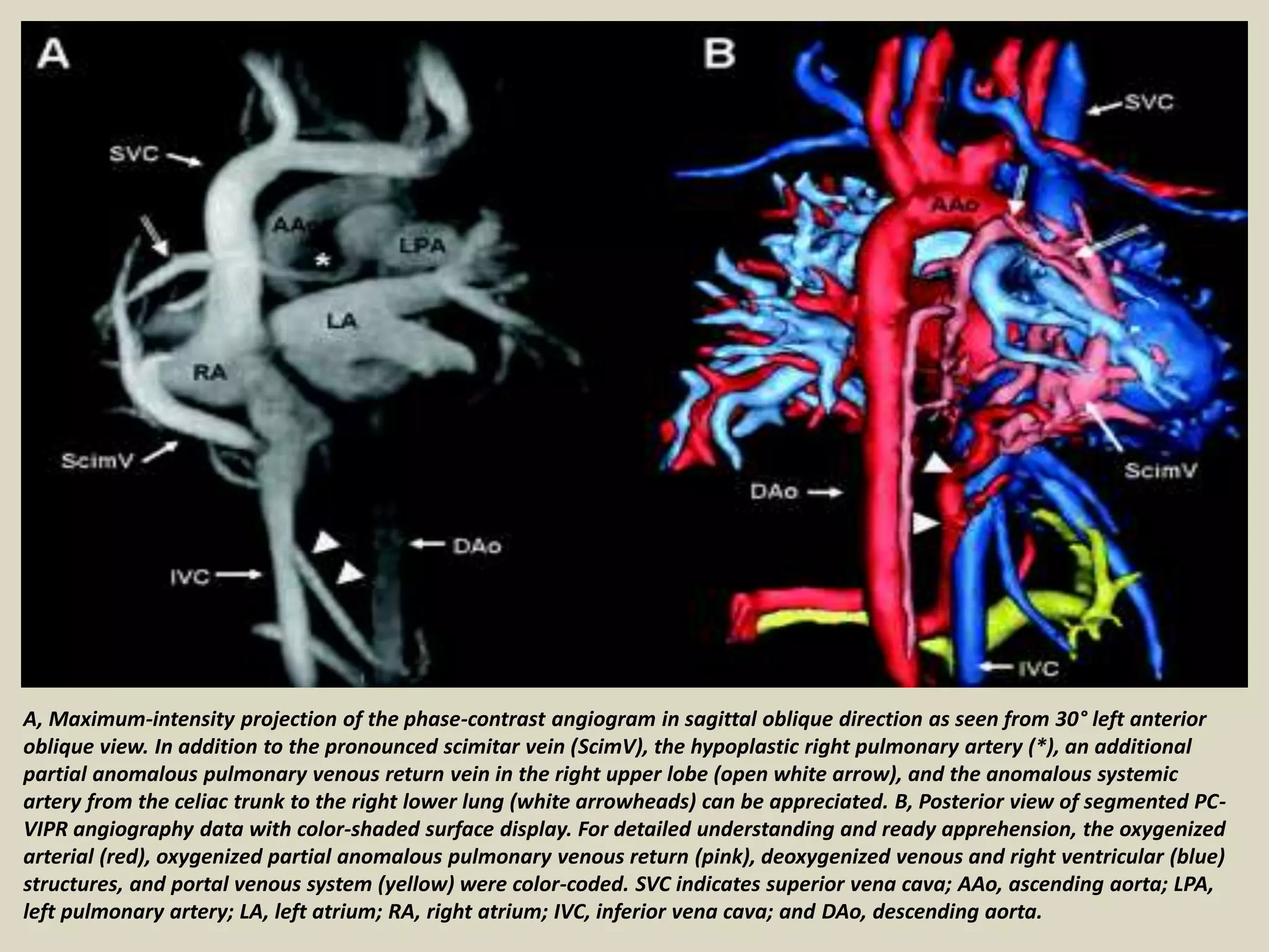 Presentation1, radiological imaging of scimitar syndrome | PPTX
