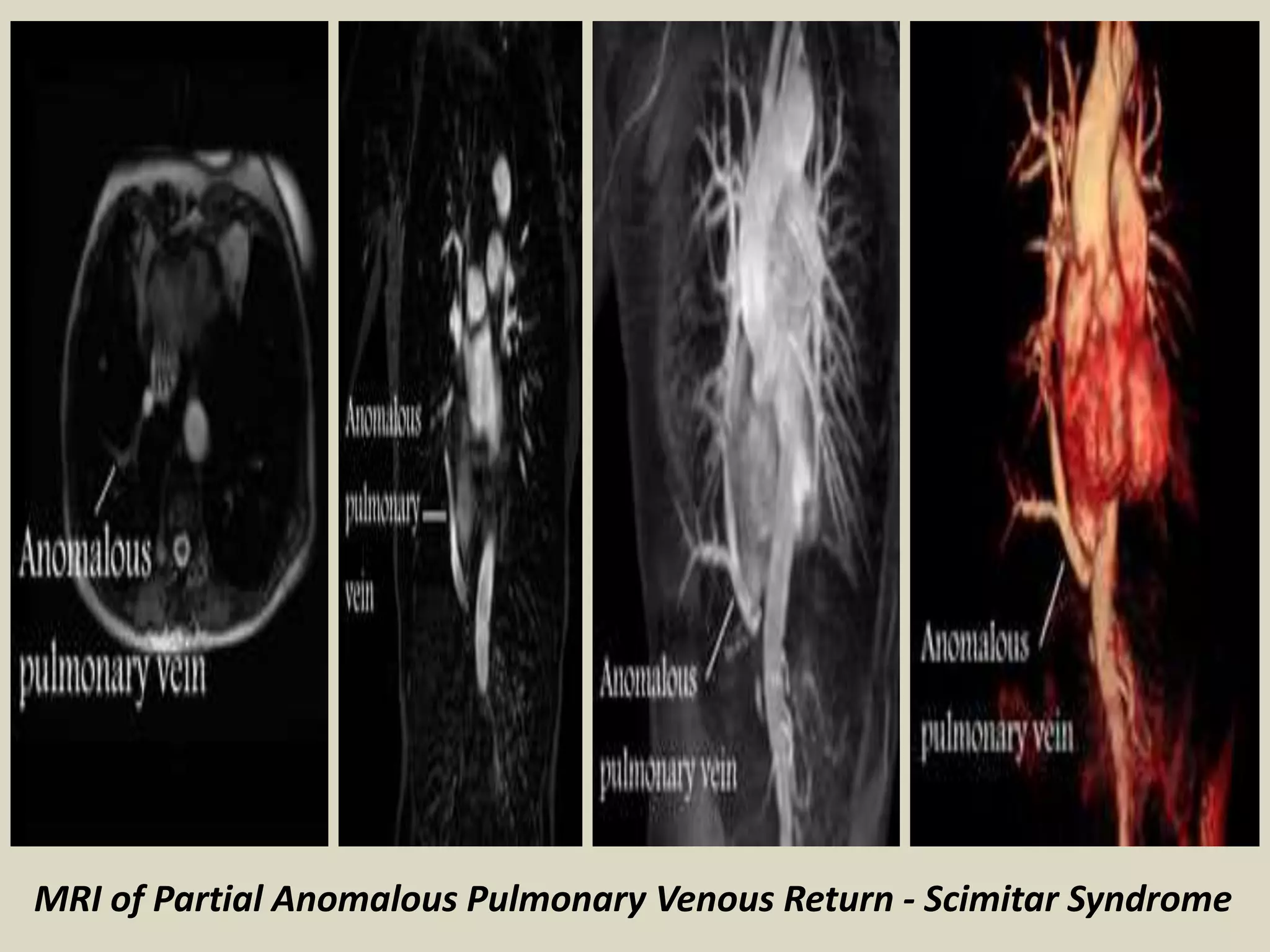 Presentation1, radiological imaging of scimitar syndrome | PPTX