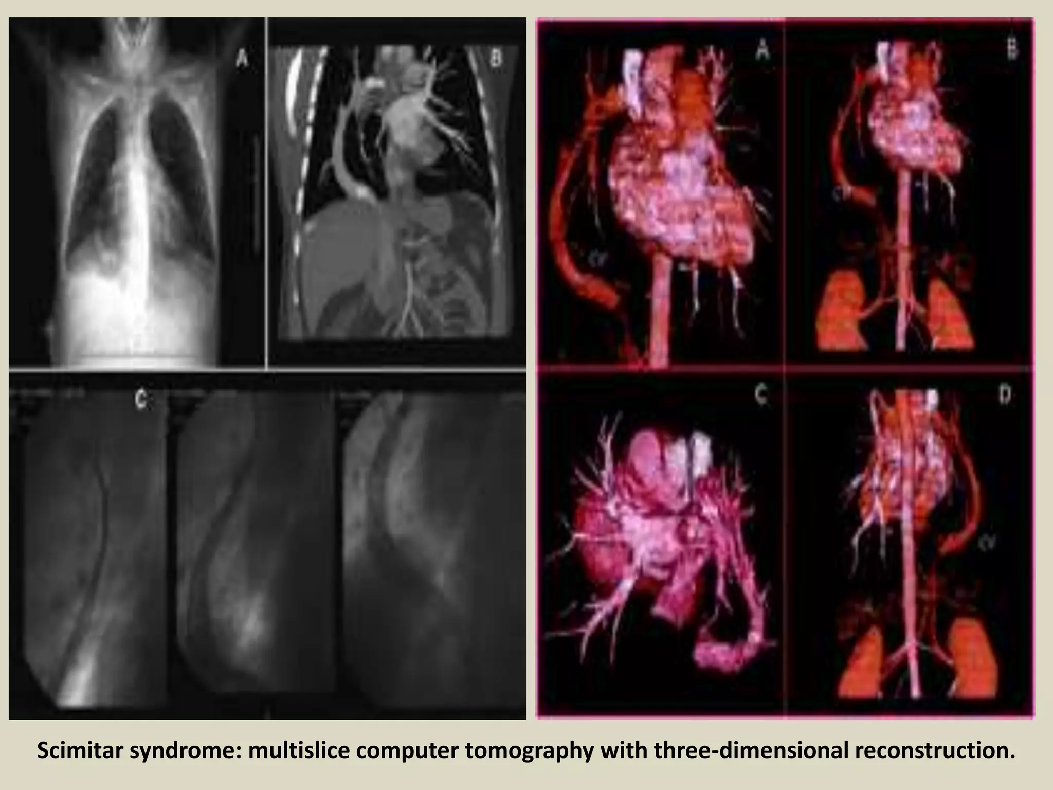 Presentation1, radiological imaging of scimitar syndrome | PPTX