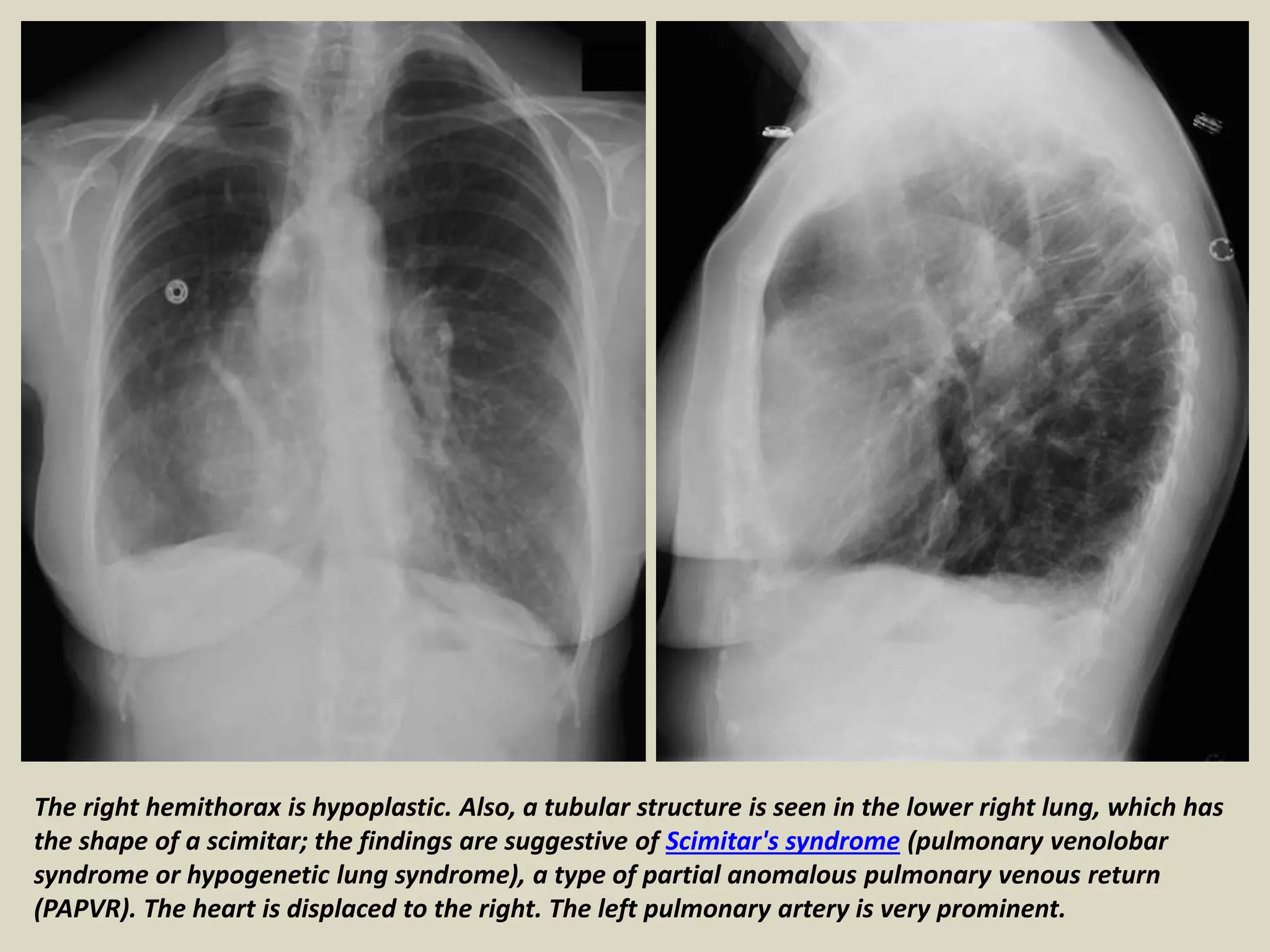 Presentation1, radiological imaging of scimitar syndrome | PPTX