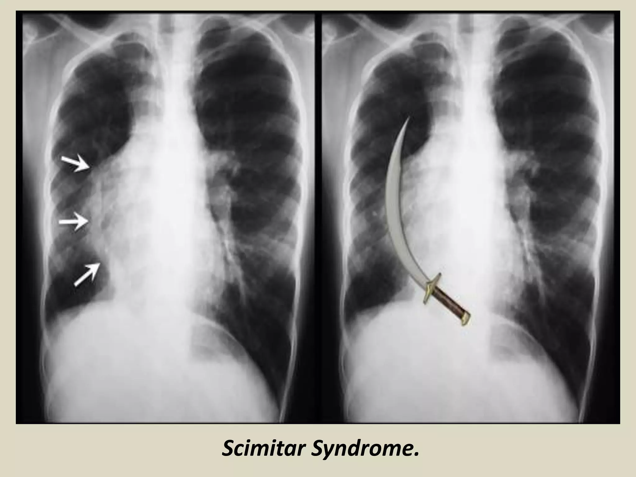 Presentation1, radiological imaging of scimitar syndrome | PPTX