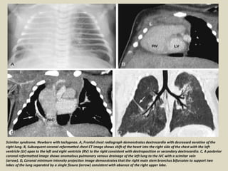 Presentation1, radiological imaging of scimitar syndrome | PPTX