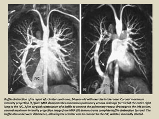 Presentation1, radiological imaging of scimitar syndrome | PPTX