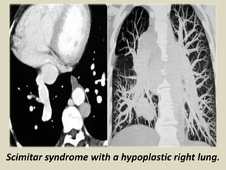 Presentation1, radiological imaging of scimitar syndrome | PPTX