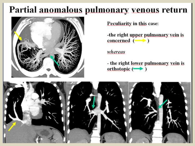 Presentation1, radiological imaging of scimitar syndrome | PPTX | Lung ...