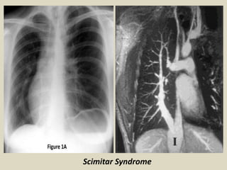 Presentation1, radiological imaging of scimitar syndrome | PPTX