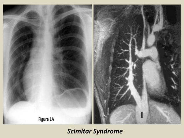 Presentation1, radiological imaging of scimitar syndrome | PPTX | Lung ...
