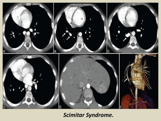 Presentation1, radiological imaging of scimitar syndrome | PPTX