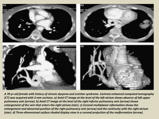Presentation1, radiological imaging of scimitar syndrome | PPTX
