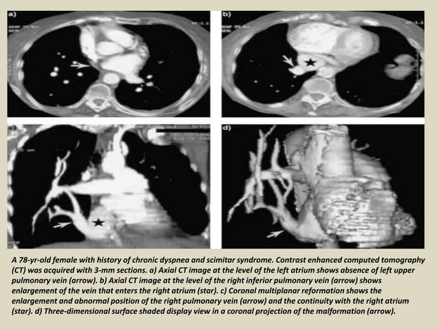 Presentation1, radiological imaging of scimitar syndrome | PPTX | Lung ...