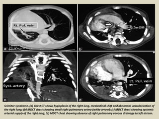 Presentation1, radiological imaging of scimitar syndrome | PPTX