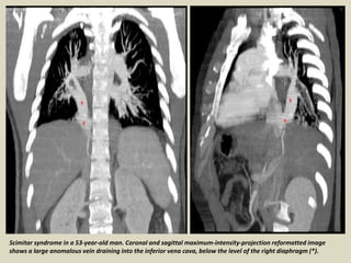 Presentation1, radiological imaging of scimitar syndrome | PPTX
