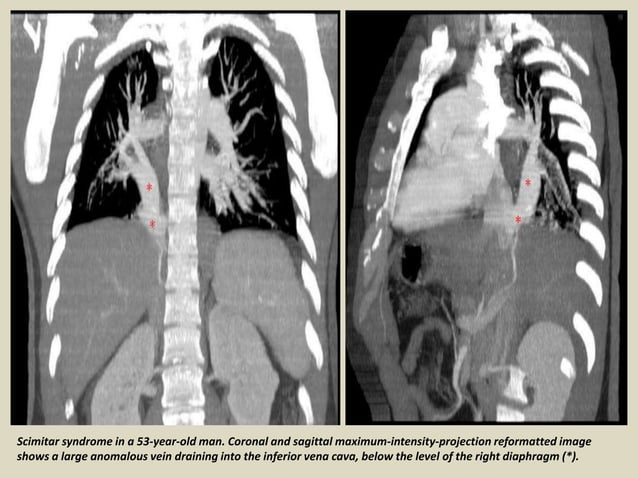 Presentation1, radiological imaging of scimitar syndrome | PPTX | Lung ...