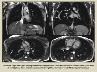 Presentation1, radiological imaging of scimitar syndrome | PPTX