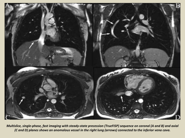 Presentation1, radiological imaging of scimitar syndrome | PPTX | Lung ...