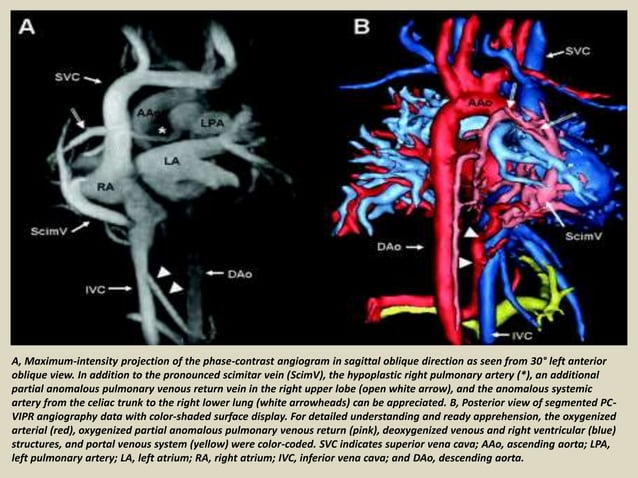 Presentation1, radiological imaging of scimitar syndrome | PPTX | Lung ...