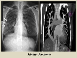 Presentation1, radiological imaging of scimitar syndrome | PPTX