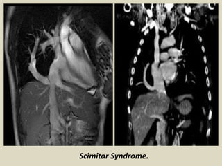 Presentation1, radiological imaging of scimitar syndrome | PPTX
