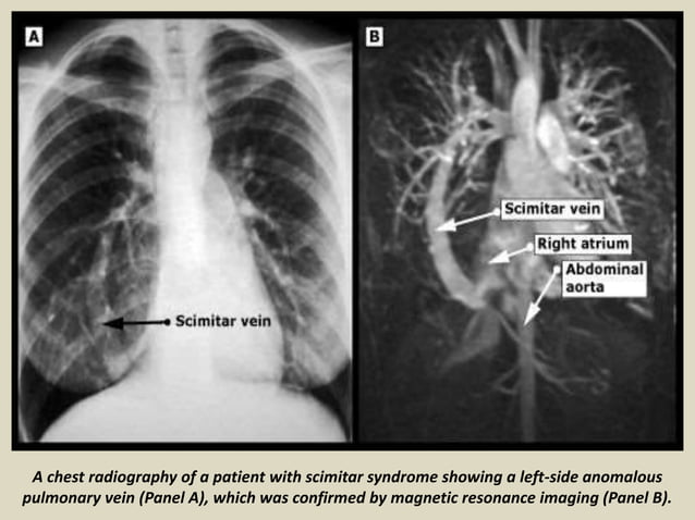 Presentation1, radiological imaging of scimitar syndrome | PPTX | Lung ...