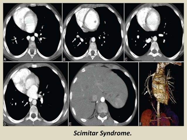 Presentation1, radiological imaging of scimitar syndrome