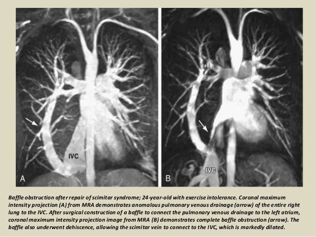 Presentation1, radiological imaging of scimitar syndrome