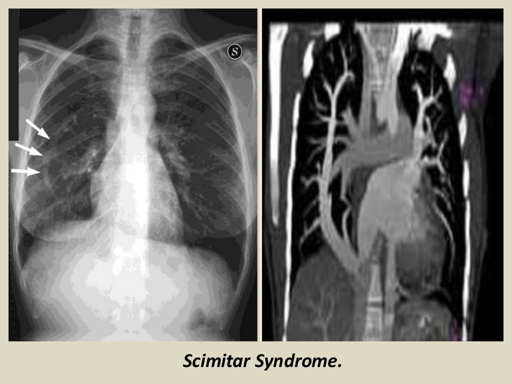 Presentation1, radiological imaging of scimitar syndrome