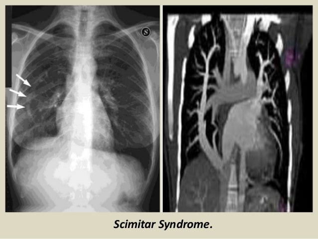 Presentation1, radiological imaging of scimitar syndrome