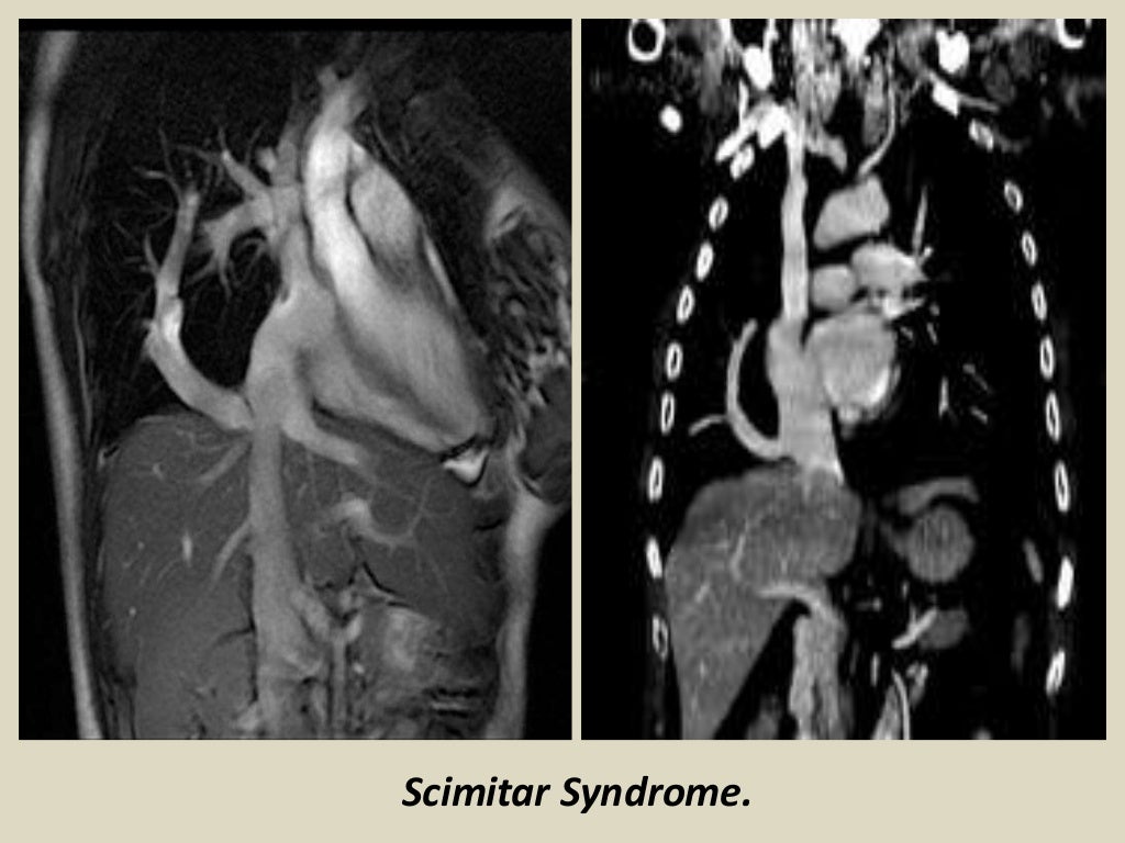 Presentation1, radiological imaging of scimitar syndrome