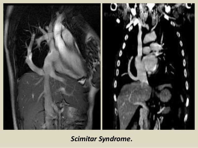 Presentation1, radiological imaging of scimitar syndrome