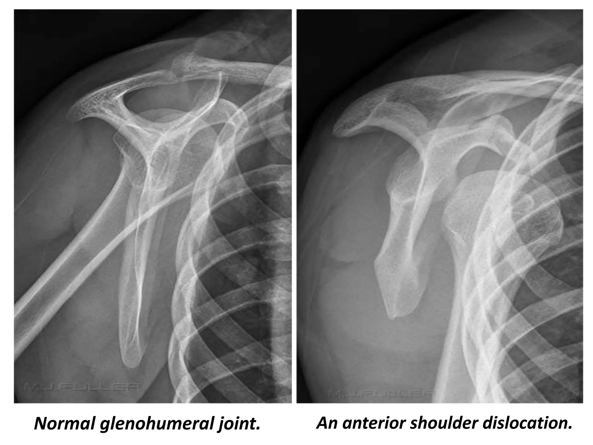 Presentation1, radiological imaging of shoulder dislocation. | PPTX