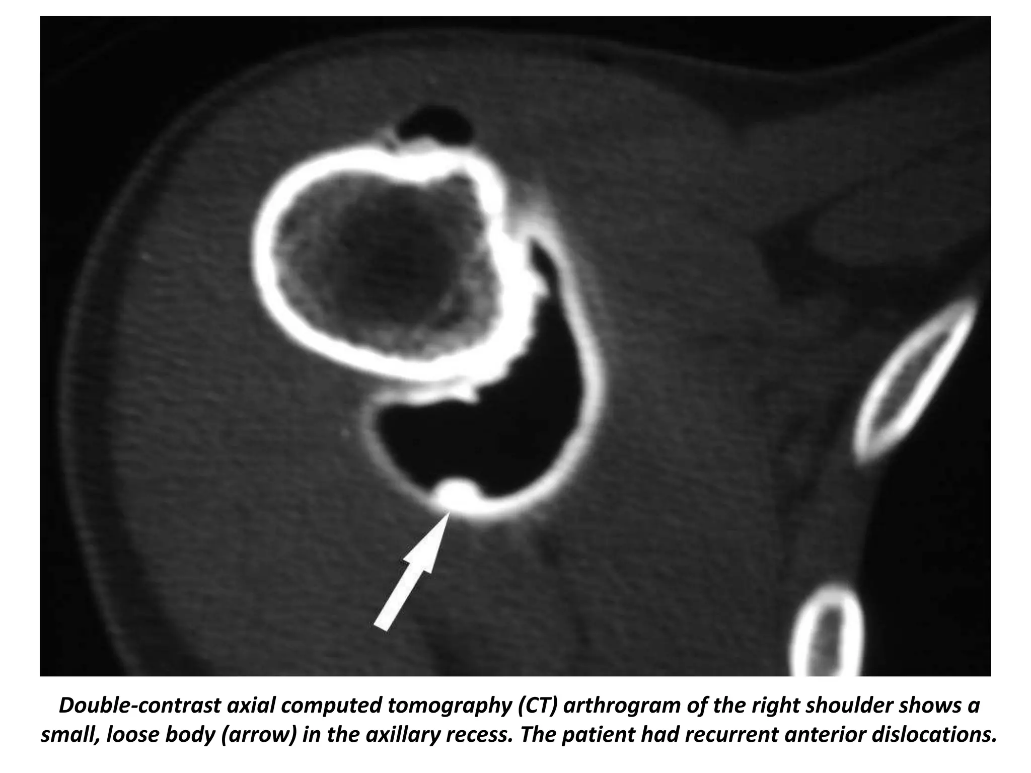 Presentation1, radiological imaging of shoulder dislocation. | PPTX